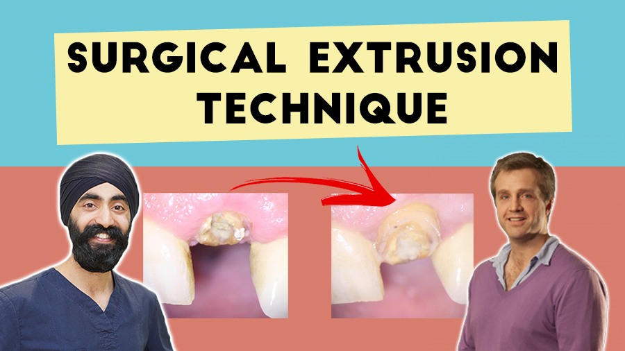 How to Save ‘Hopeless’ Teeth with the Surgical Extrusion Technique ...