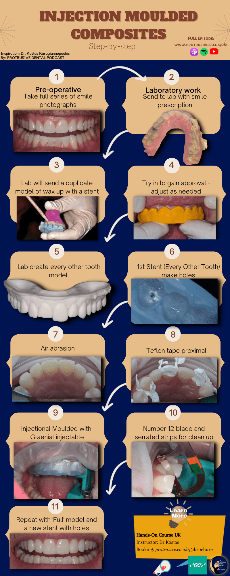 How to use Injectable Composites to Treat Toothwear – PDP081 ...