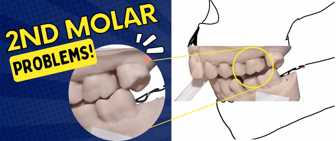 Last Tooth In the Arch Syndrome – 2nd Molar Conundrums – PDP130 ...