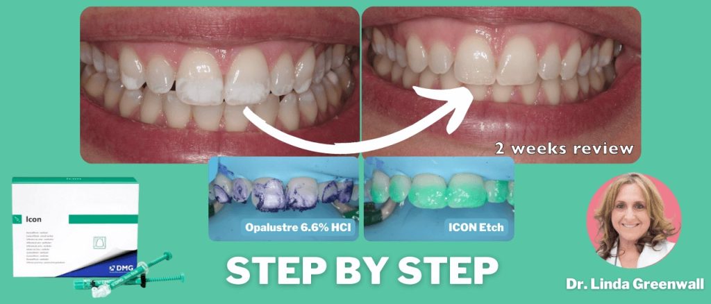 ICON Resin Infiltration – Step by Step FULL PROTOCOL – PDP140 ...