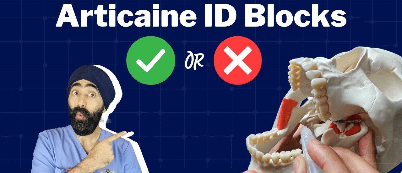 Articaine ID Blocks and the ‘CIA Technique’ for Local Anaesthetic ...