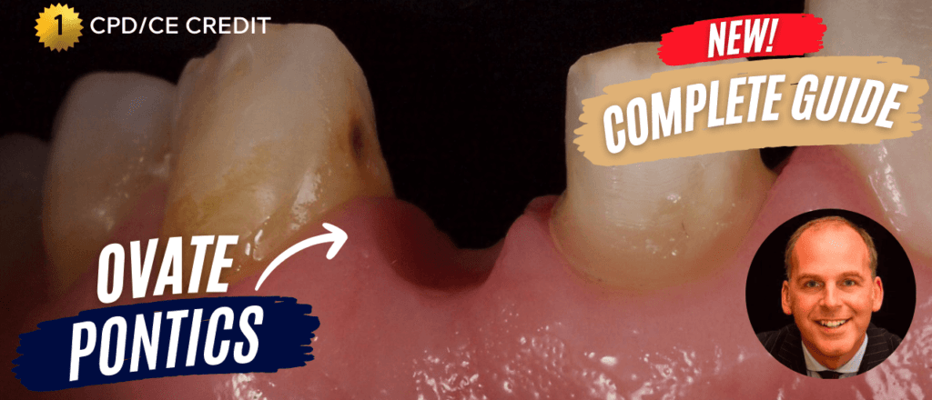 Ovate Pontics for Bridges – The Complete Guide with Dr Jason Smithson ...