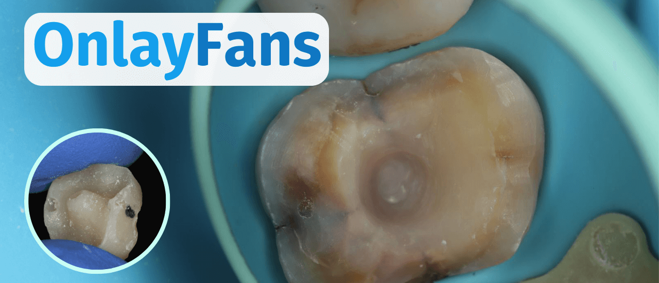 A Geeky Discussion on Adhesive Onlays – PDP161 – Protrusive Dental Podcast