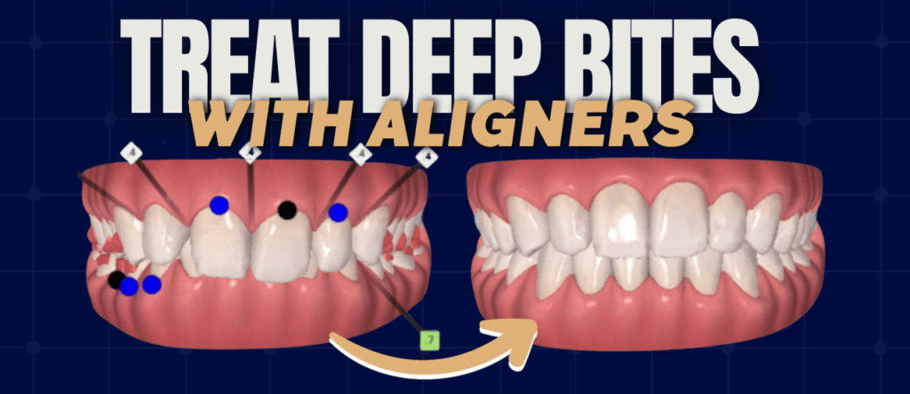 Deep Bites and Aligners – How to Improve Predictability – PDP170 ...