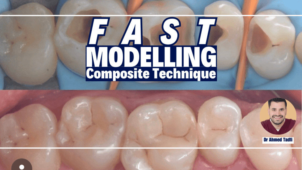 The Fast Modelling Technique for Efficient and Esthetic Posterior ...
