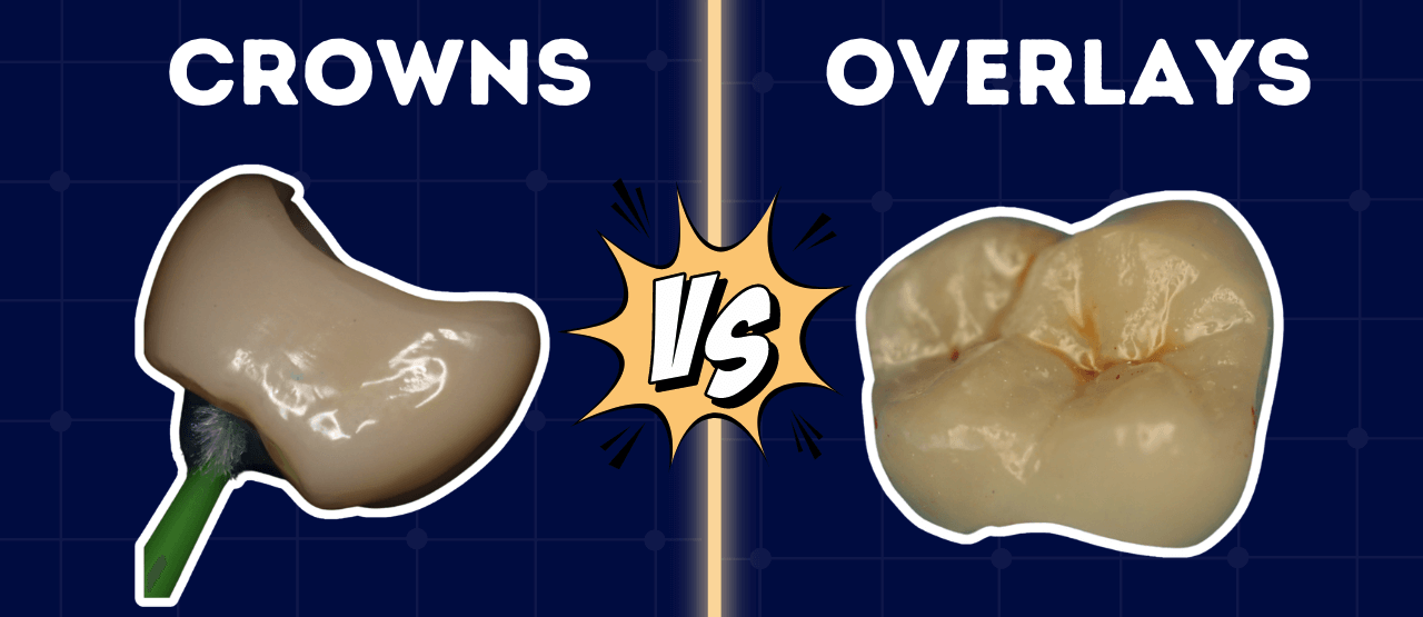 Onlays Vs Full Crowns – Decision Making 2024 – PDP189 – Protrusive ...