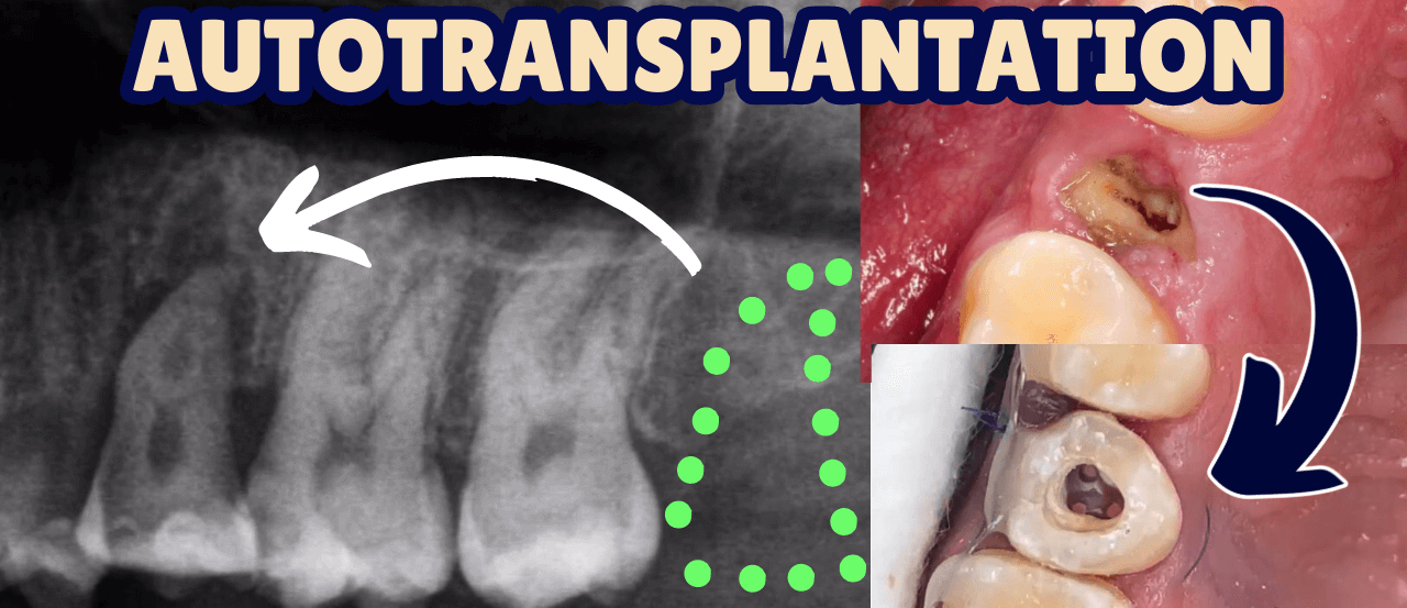 Replacing Premolars with Wisdom Teeth – Autotransplantation by a GDP ...