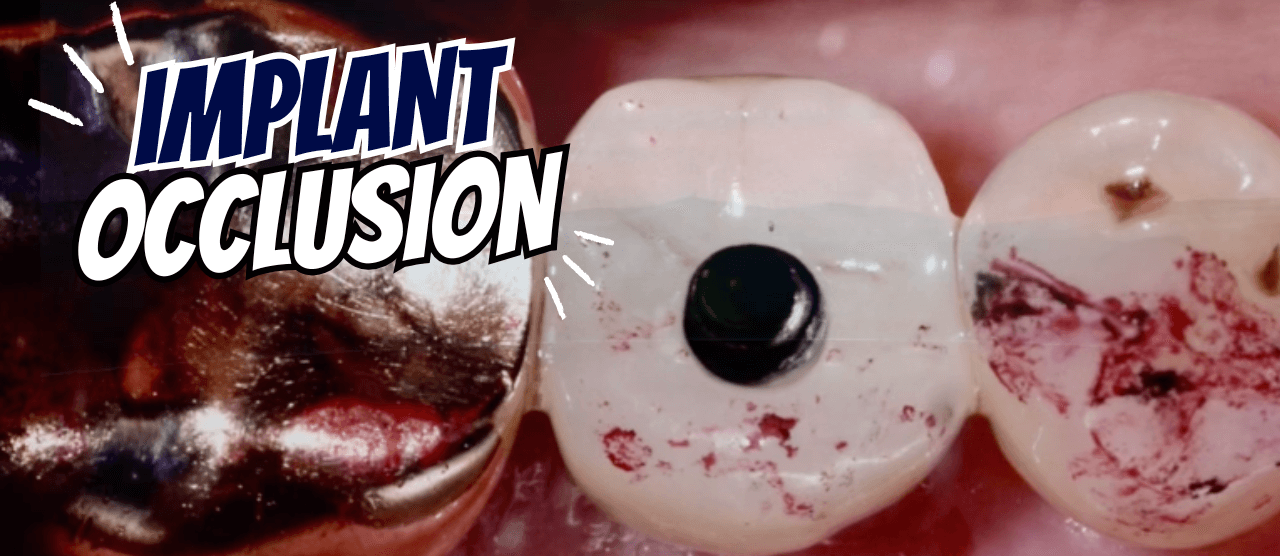 Implant Occlusion that Makes Sense! – PDP204 – Protrusive Dental Podcast