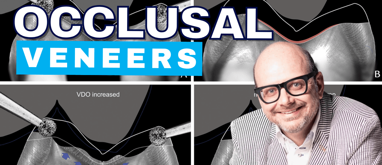 Pascal Magne on Occlusal Veneers and Material Selection – PDP221 ...