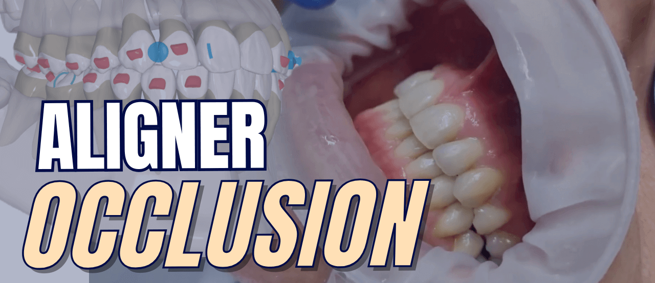 Occlusion for Aligners – Clinical Guidelines for GDPs – PDP250 ...