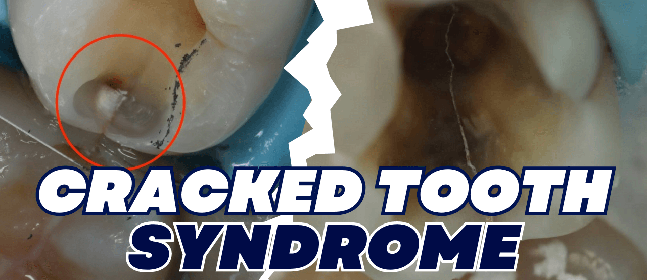 Understanding Cracked Tooth Syndrome and the Dental Occlusion Triad ...